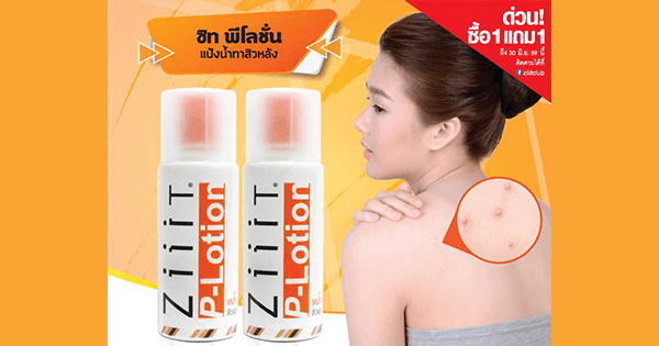 บอกลาสิวที่หลังกันเถอะ! กับโปรโมชั่นแรงๆ จาก ZiiiT